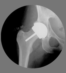 Heupprothese - Orthopedisch Centrum Kortrijk AZ Groeninge