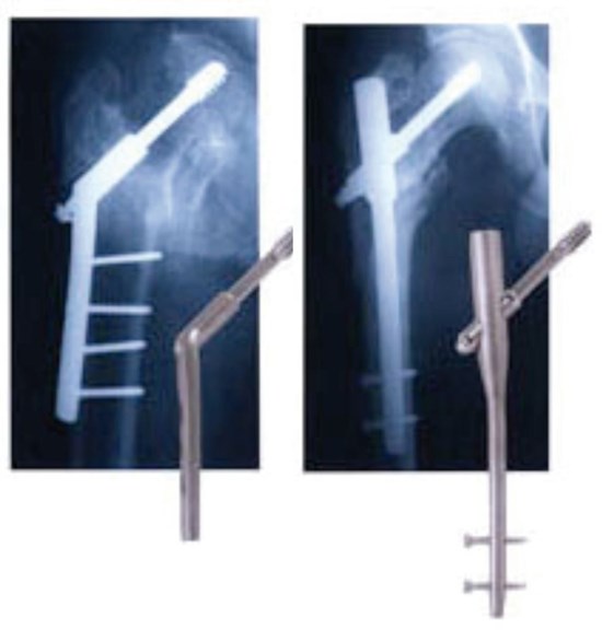 Heupfractuur - Orthopedisch Centrum Kortrijk AZ Groeninge