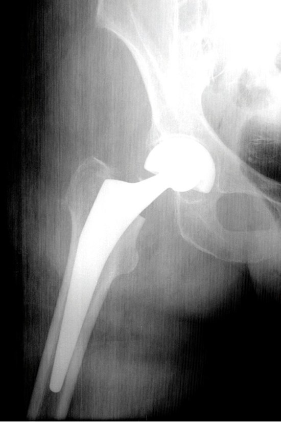 Heupfractuur - Orthopedisch Centrum Kortrijk AZ Groeninge