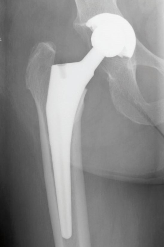 Heupfractuur - Orthopedisch Centrum Kortrijk AZ Groeninge